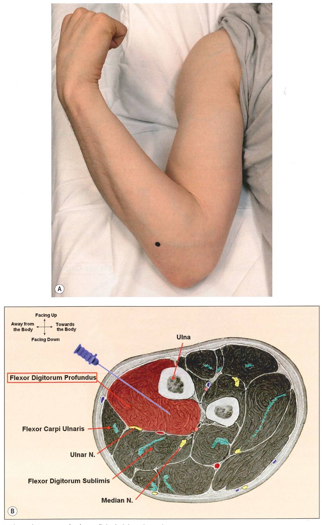 FlexorDigitorum Sublimis